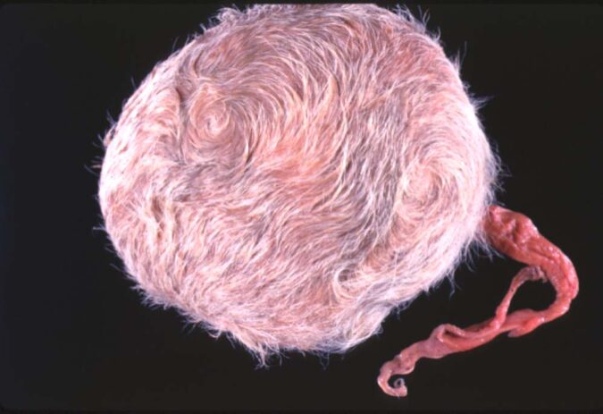 Amorphous Globosus - Pathology and Ponies