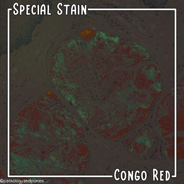 Special Stain: Congo Red - Pathology and Ponies